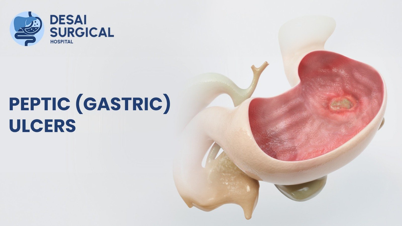 Peptic (Gastric) Ulcers - Desai Surgical Hospital