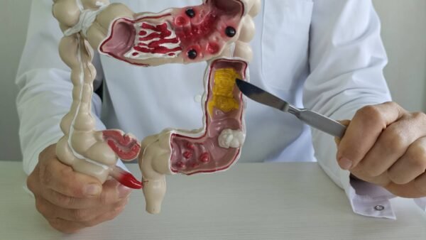 Colonic Polyps & Cancer: Symptoms, Causes & Treatment